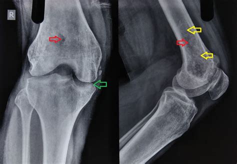 Multiple Bone Infarcts With Intra Articular Extension Bmj Case Reports