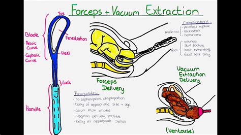 Definition Of The Vacuum Extraction At Hudson Facy Blog