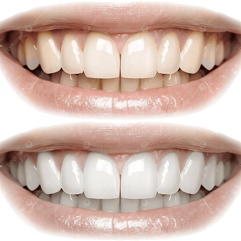 건강한 치아 미백 희게 함 이빨 이의 Png 일러스트 및 이미지 에 대한 무료 다운로드 Pngtree