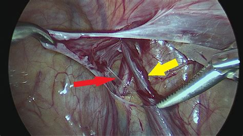 Further Sharpblunt Dissection And Separation Of Vas Deferens Solid