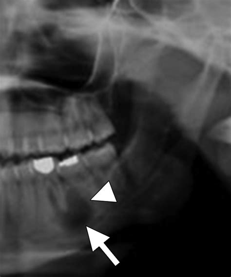 Mandibular Canal Radiograph