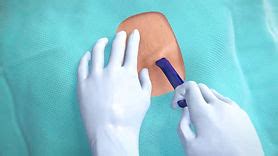 Implantable Loop Recorder Leyva