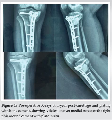 Rare Coexistence Giant Cell Tumor Recurrence And Infection In The Proximal Tibia A Case