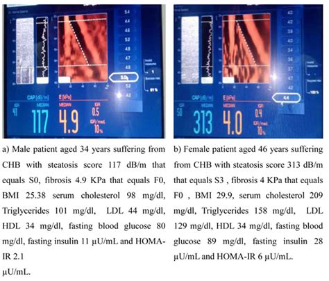 Assessment Of Hepatic Steatosis In Patients With Chronic Hepatitis B