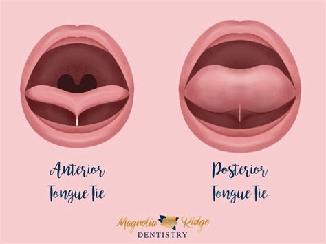 Tongue And Lip Tie Release In Melissa Tx Magnolia Ridge Dentistry