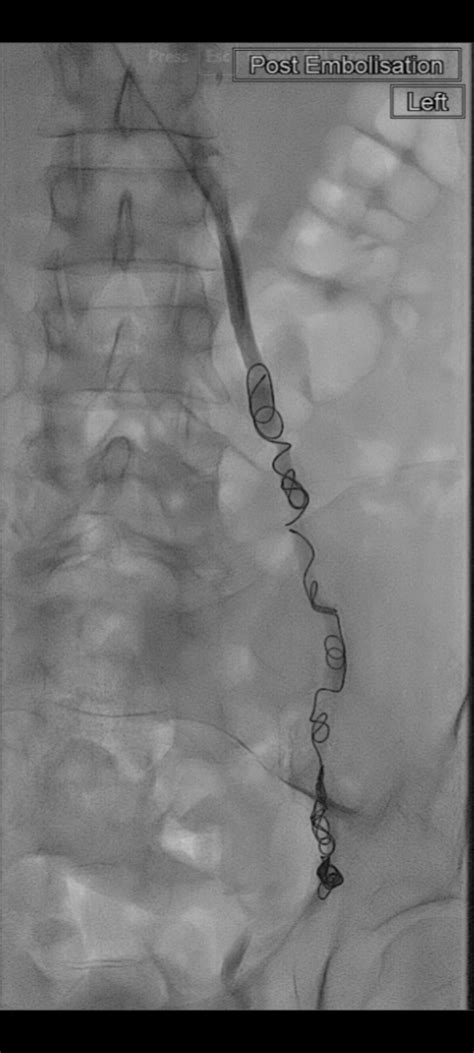 Embolisation Images And Flouroscopy Record R Varicocele