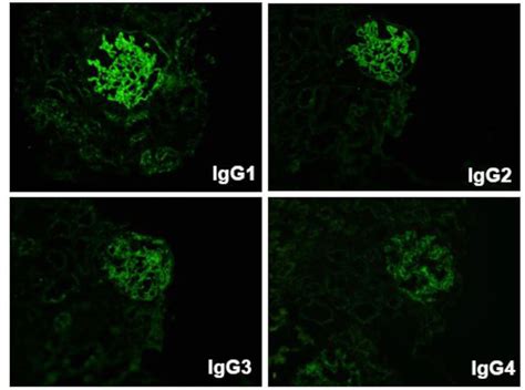 Immunofluorescence Showed Staining Of Igg Subclasses In A Patient With