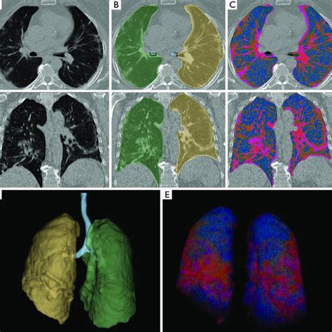 Process Of Anatomic And Pathologic Segmentation A Example Of A Ct