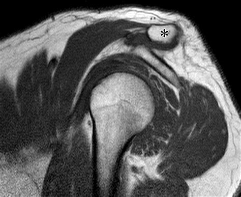 Imaging Of The Acromioclavicular Joint Anatomy Function Pathologic Features And