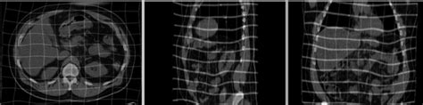 modules deformableb splineregistration documentation 3 6 slicer wiki