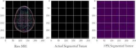 Figure 1 From Design And Comparison Of Tumor Segmentation Using An Ml Based Clustering Method