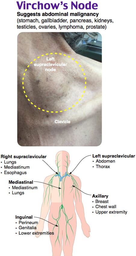 Virchows Node Is A Medicine Keys For Internal Medicine