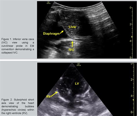 Figure 1 From Pocus Confirmation Of Intraosseous Line Placement