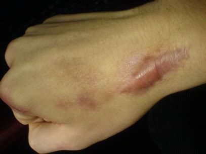 Keloid Scars After Trauma