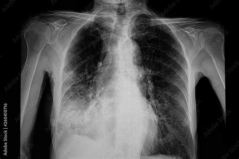 Follow Up Chest X Ray After Covid Pneumonia At Patrick Lakes Blog