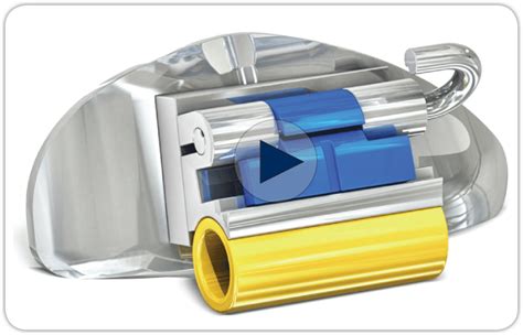 Speed System Orthodontics