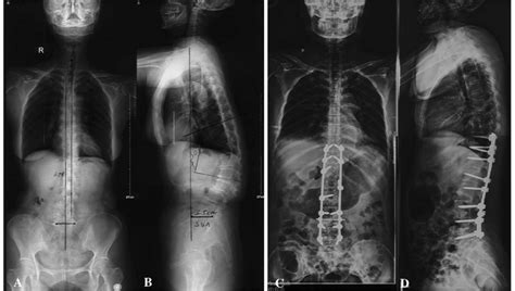 68 Year Old Female With Degenerative Lumbar Scoliosis Who Is Receiving