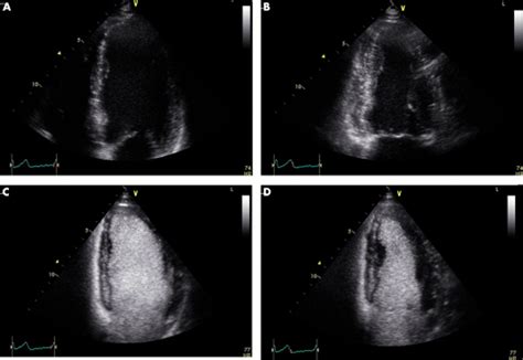 Contrast Echocardiography Heart