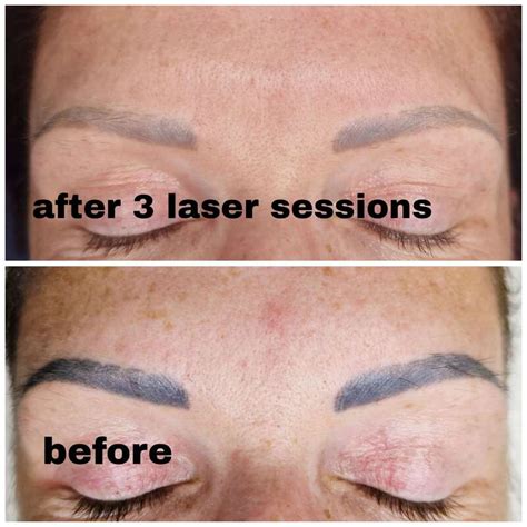 Tattoo Removal Healing Process