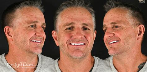 Transformations By Teeth On Implants Teeth On Implants