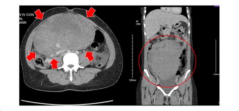 Computed Tomography Ct Of The Abdomen And Pelvis Revealing Solid