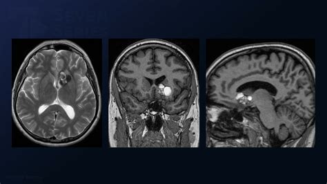 341 Anterior Interhemispheric Contralateral Transcallosal Approach