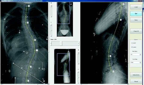statistical shape models of the spine radiology key