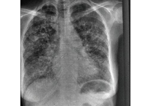 Chest X Rays Flashcards Quizlet