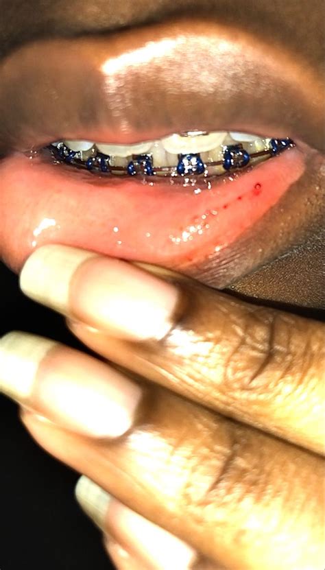 Braces 😔 Braces Colors Getting Braces Power Chain Braces