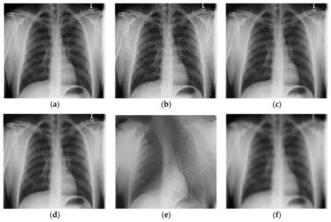 Denoising Of X Ray Images Using The Adaptive Algorithm Based On The Lpa Rici Algorithm