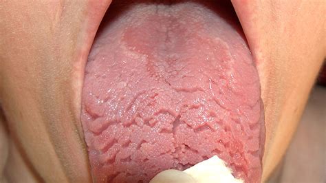 Health Tongue Problems Yellow Tongue Causes Symptoms Treatment And