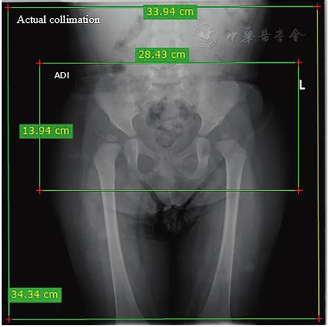 X Ray Beam Collimation In Radiography A Study Of Compliance Among