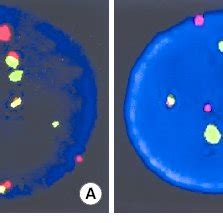 RUNX RUNX T Gene Rearrangement Detected By FISH A Result Of FISH Download Scientific