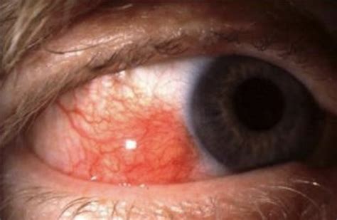 Inflammatory Eye Disease Flashcards Quizlet