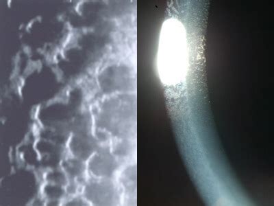 Corneal Guttata