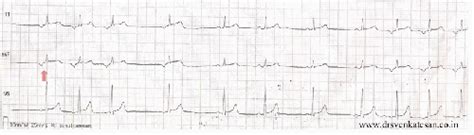 Wandering Pacemaker Dr S Venkatesan Md