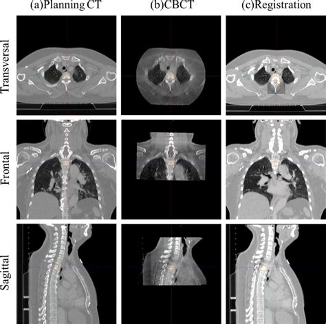 Image Registration Using Varian Cone Beam Computed Tomography Cbct Download Scientific