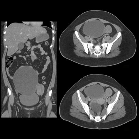 Pediatric Paraovarian Cyst Pediatric Radiology Reference Article