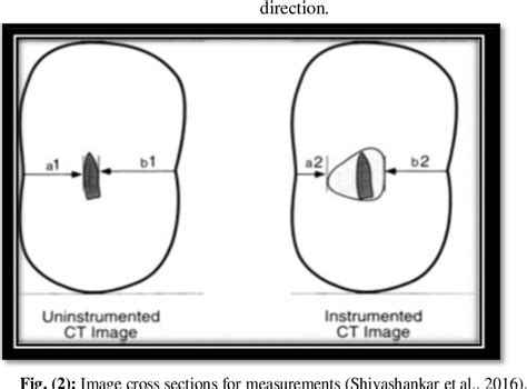 Table 12 From Shaping Ability Of Different Single Niti Files A Cbct Assessment Semantic Scholar