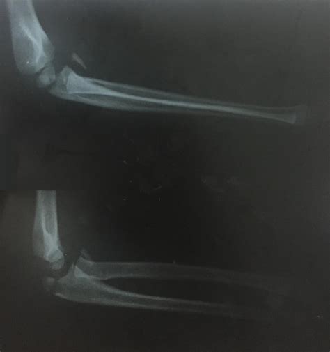 Elbow Dislocation Pediatric Pediatrics Orthobullets