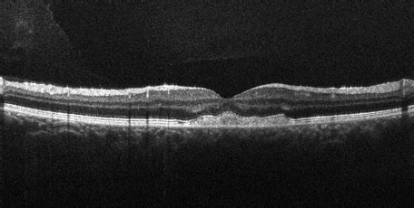 Central Serous Chorioretinopathy Cscr The Retina And Macula Centre