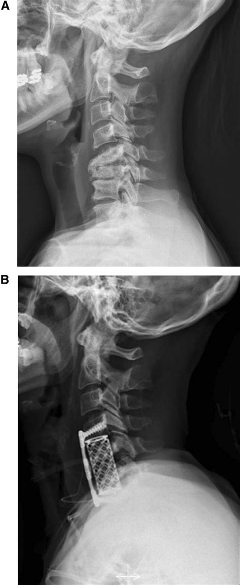Focal Kyphosis Definition At Ava Ewers Blog