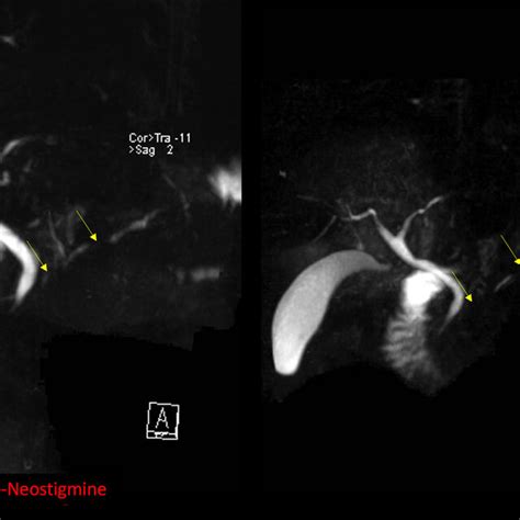 Mrcp In A 21 Year Old Female Patient With A History Of Recurrent Acute Download Scientific