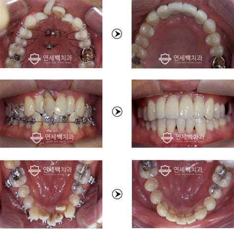 연세백치과 칼럼 제 나이에도 교정치료가 가능한가요