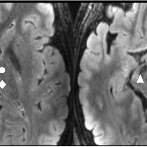 Axial Flair Sequences Demonstrating Epilepsy Dbs Targets—anterior
