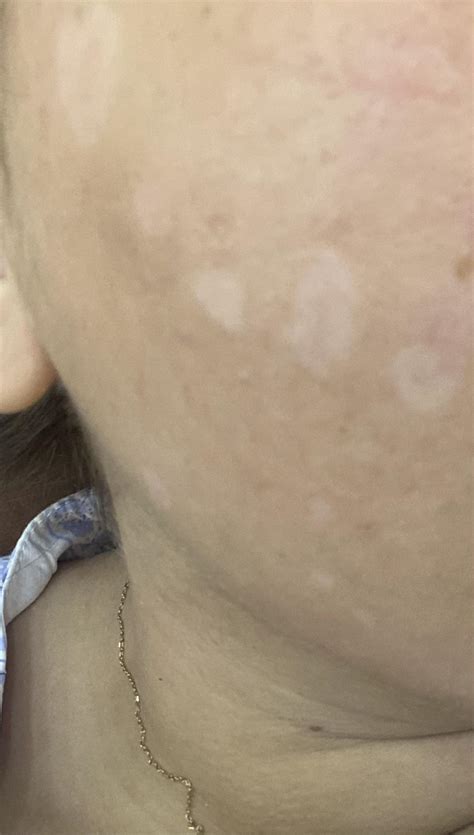 How To Get Rid Of White Spots After Healed Psoriasis Rpsoriasis