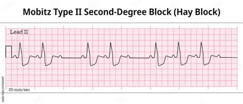 Hay Block Ecg Mobitz Type 2 Second Degree Atrioventricular Block