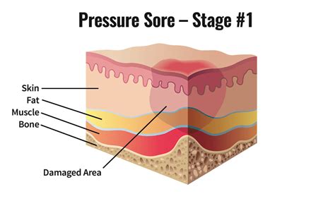 Stage 1 Pressure Ulcer