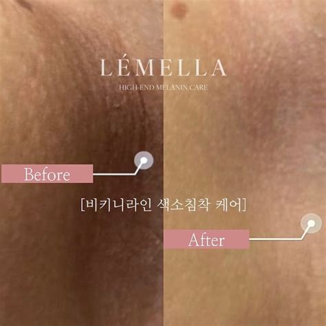 르멜라본사 하이엔드 멜라닌 색소침착 케어 비키니라인 ‘르멜라 시술 1회 3주 케어크림 변화 착색정도에 따라 변화의 차이가 생길 수 있습니다 •반영구문신이