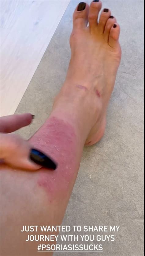 Psoriasis Kim Kardashian